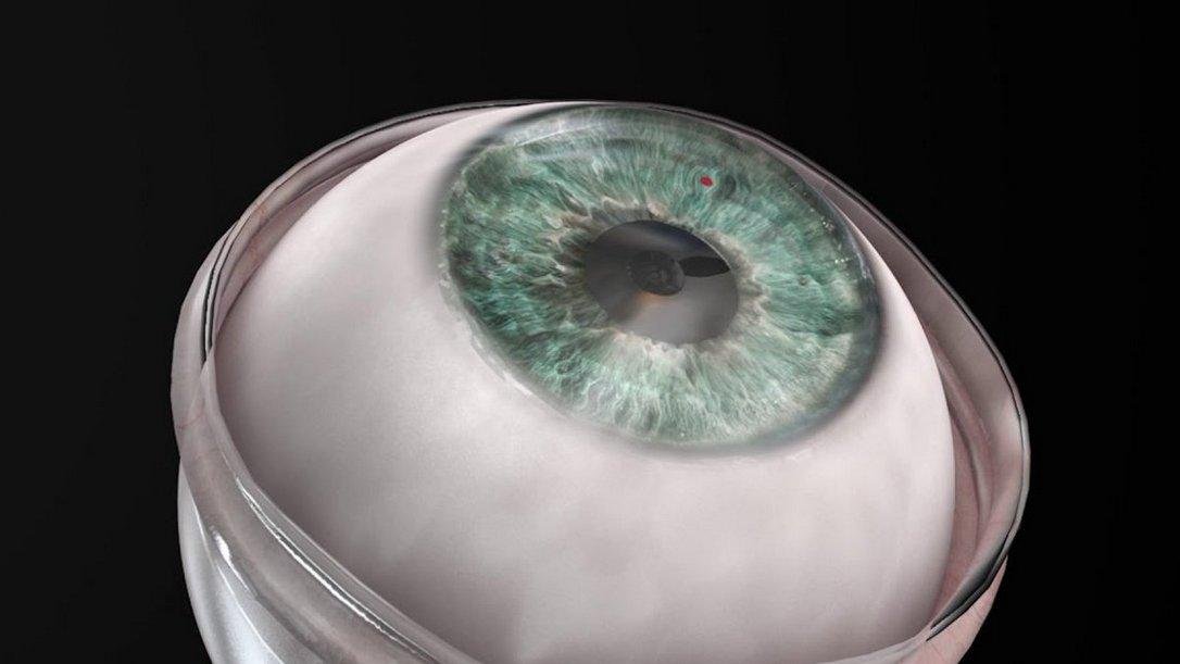 Synthetic Cornea transplant restores the sight of a 78-yr old blind man ...